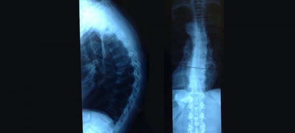 Hyperkyphosis - Scoliosis Physiotherapy